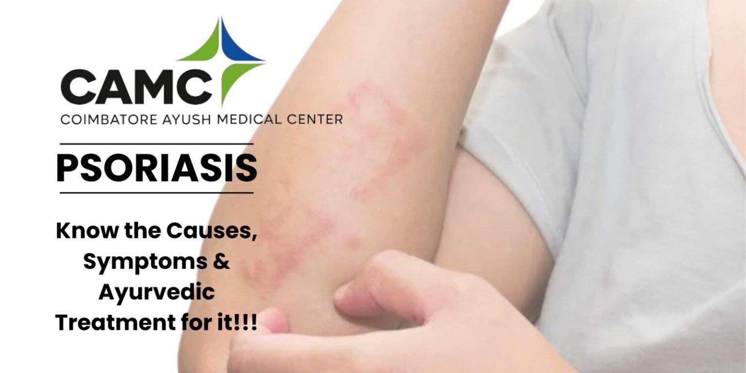 Psoriasis and Its Management According To Ayurveda - Coimbatore Ayush ...